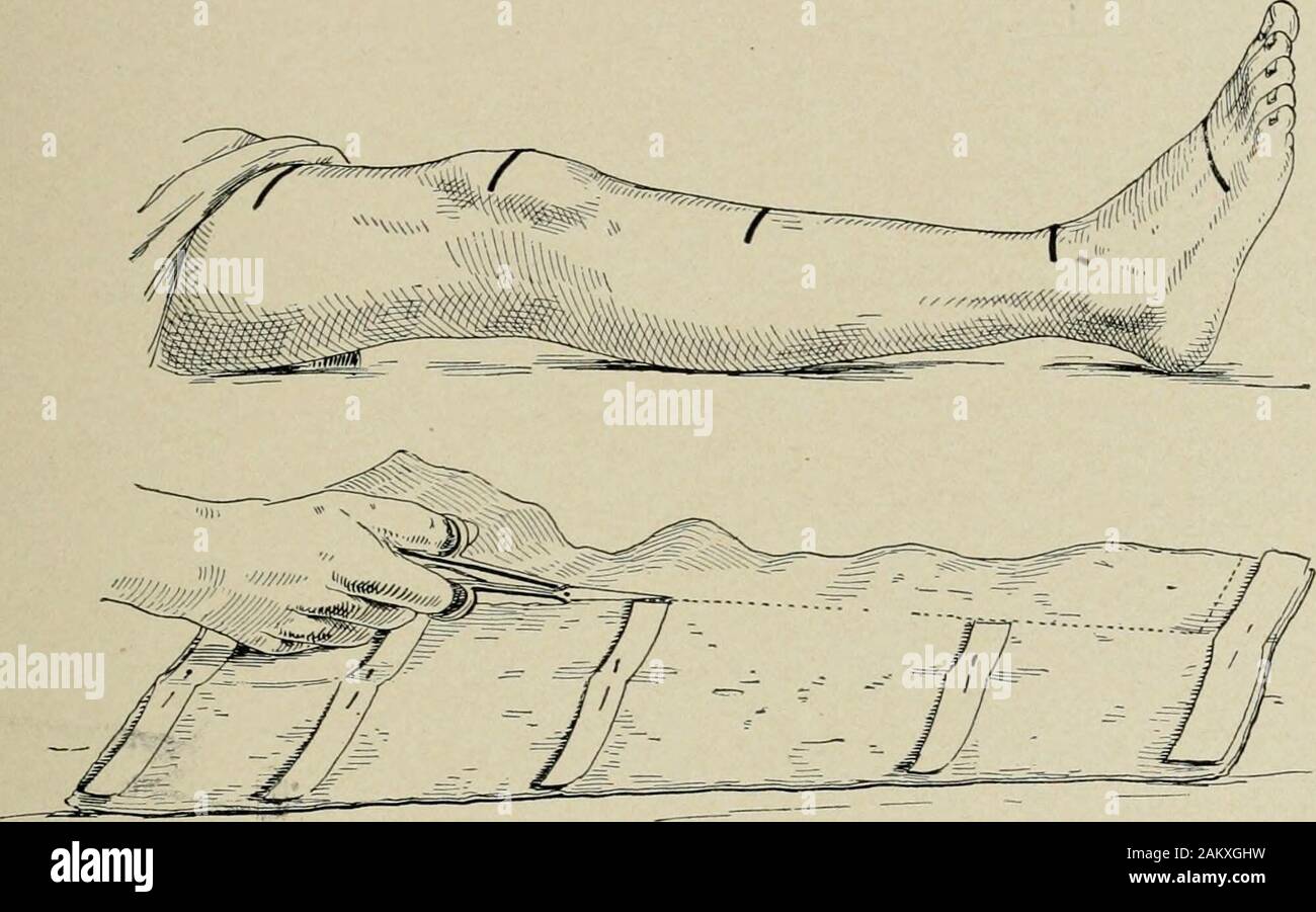 Tibia fibular fracture hi-res stock photography and images - Alamy