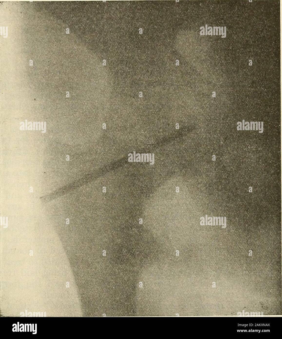 Intracapsular fracture hi-res stock photography and images - Alamy