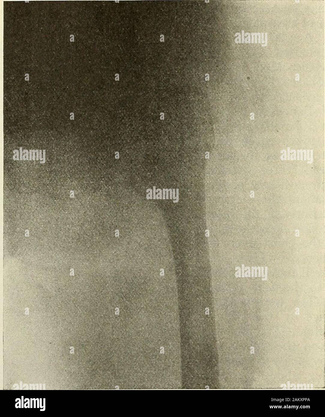 Modern surgery, general and operative . Fig. 336.—Coaptation traction ...