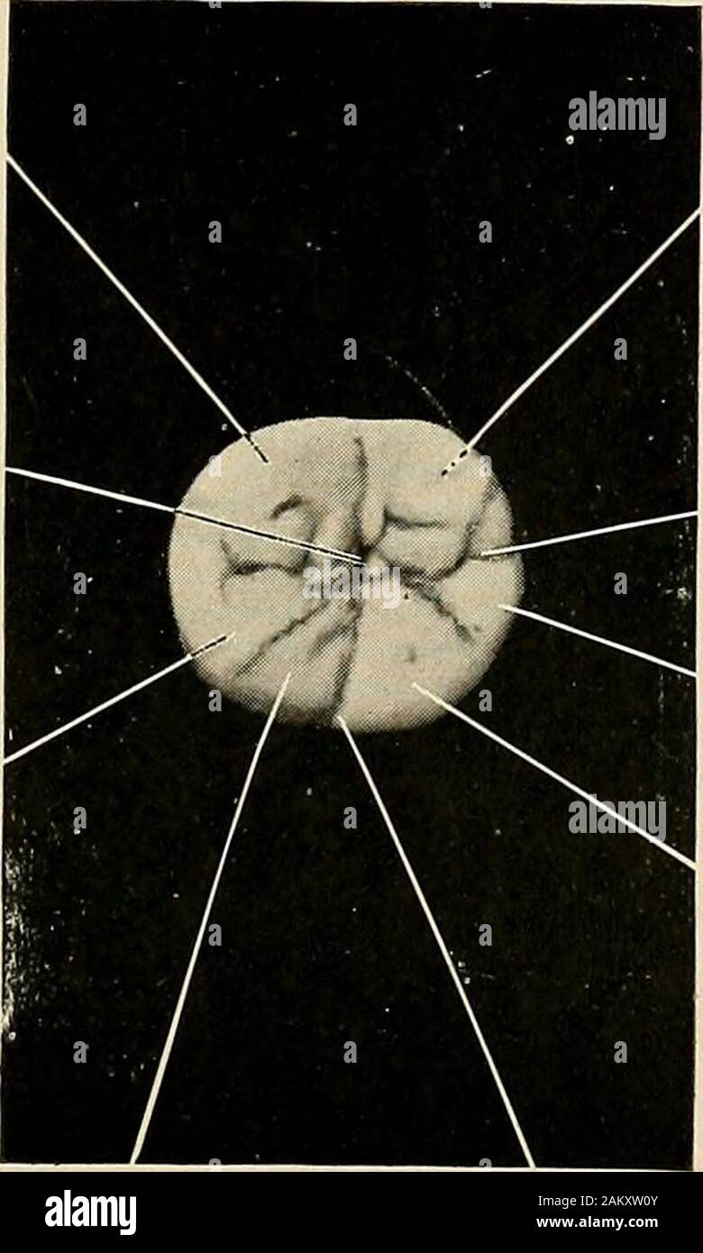 Principles and practice of operative dentistry . Disto-buecal cusp Fig ...