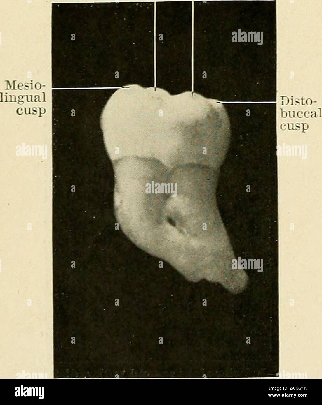 Third molar hi-res stock photography and images - Alamy