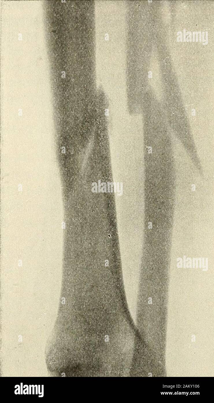 Supinator muscle hi-res stock photography and images - Alamy