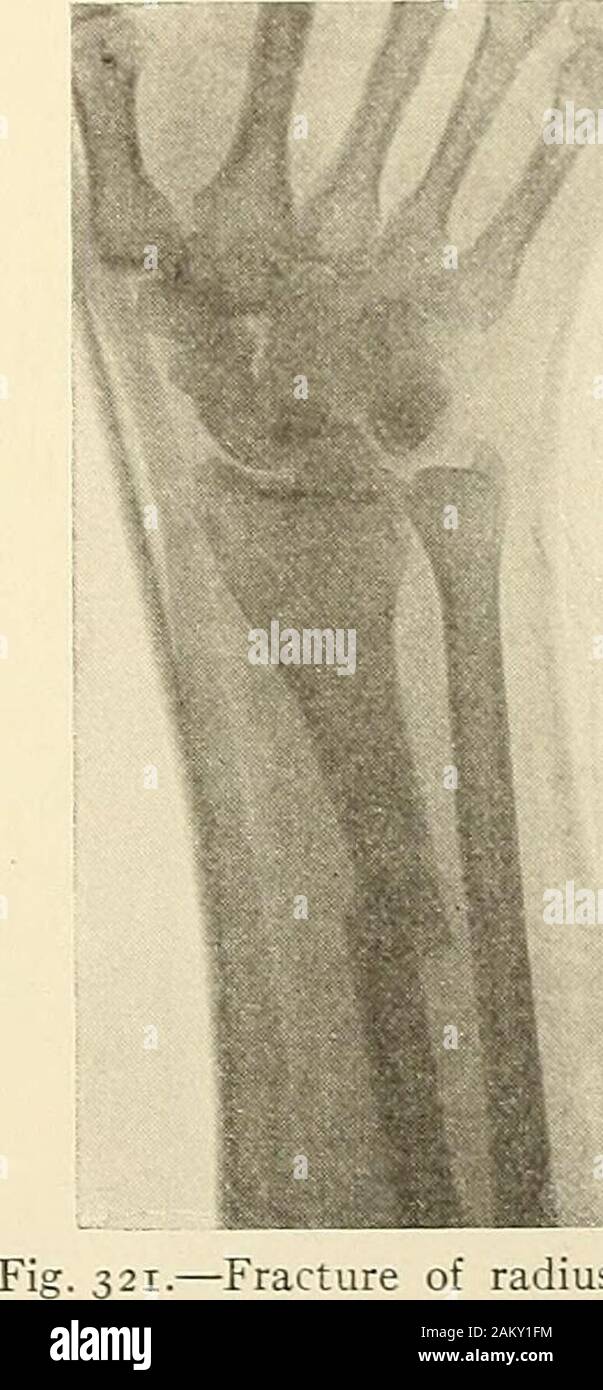 Supinator muscle hi-res stock photography and images - Alamy