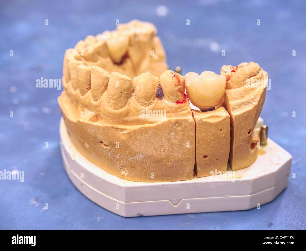Dental bridge in tweezers hi-res stock photography and images - Alamy