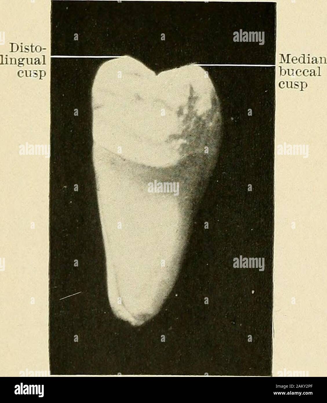 Molar inferior hi-res stock photography and images - Alamy