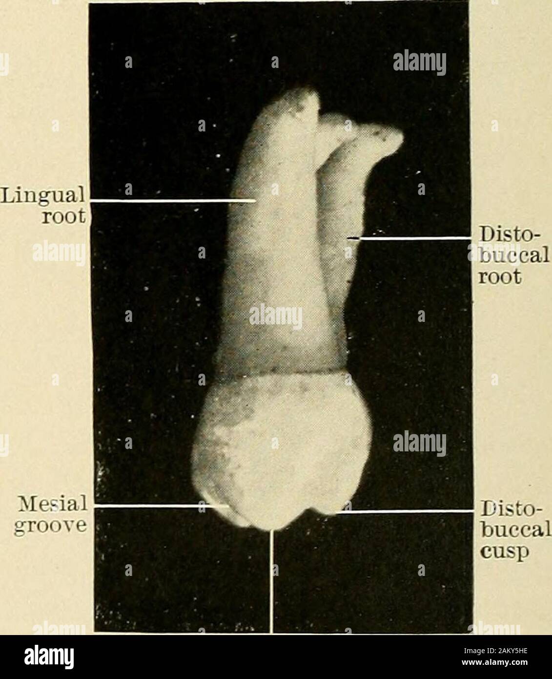 Principles and practice of operative dentistry . Fig. 63. Mesio ...