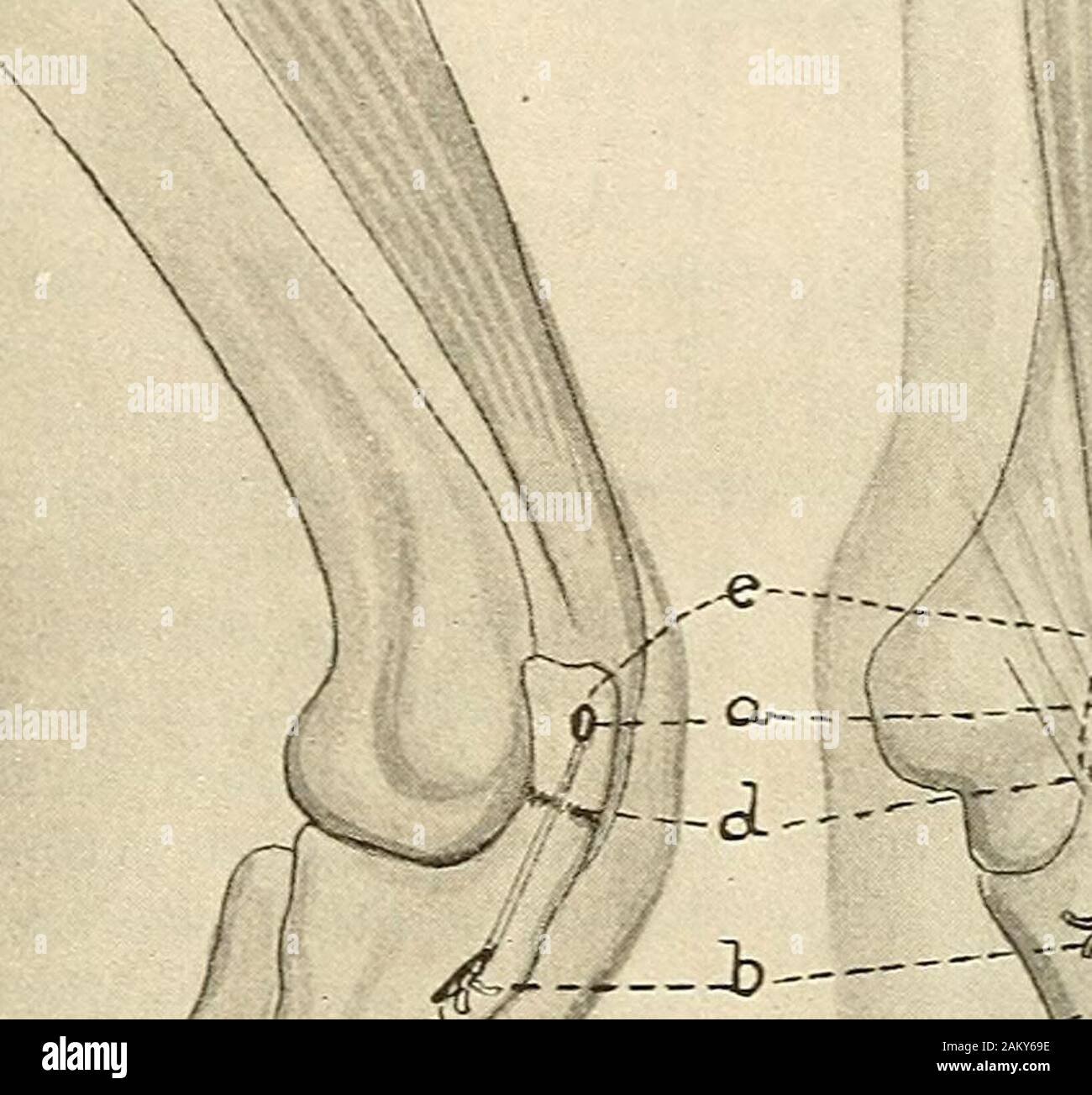 Olecranon fracture hi-res stock photography and images - Alamy