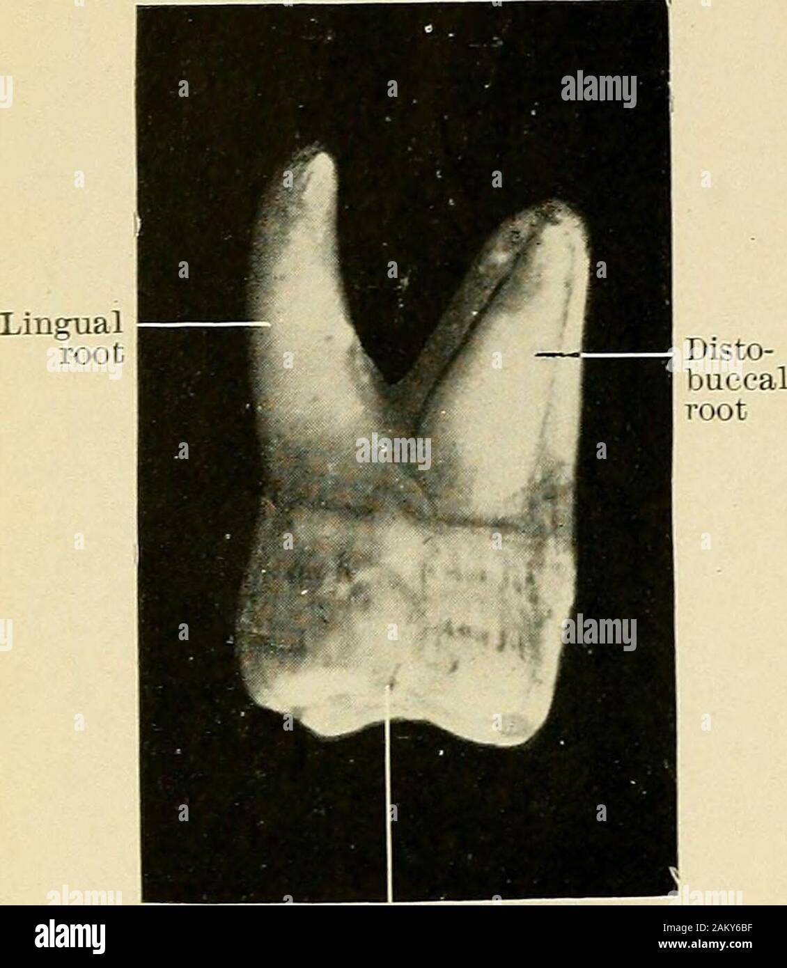 Principles and practice of operative dentistry . Lingual grooveFig. 59 ...
