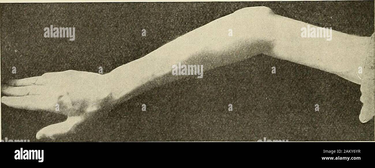 Olecranon process fracture hi-res stock photography and images - Alamy