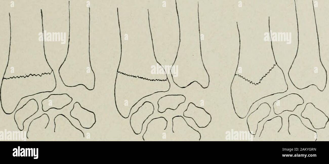 Transverse bone fracture hi-res stock photography and images - Alamy
