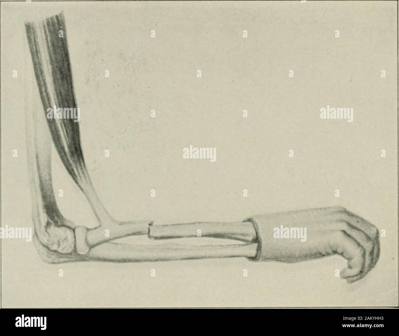 Long supinator muscle hi-res stock photography and images - Alamy