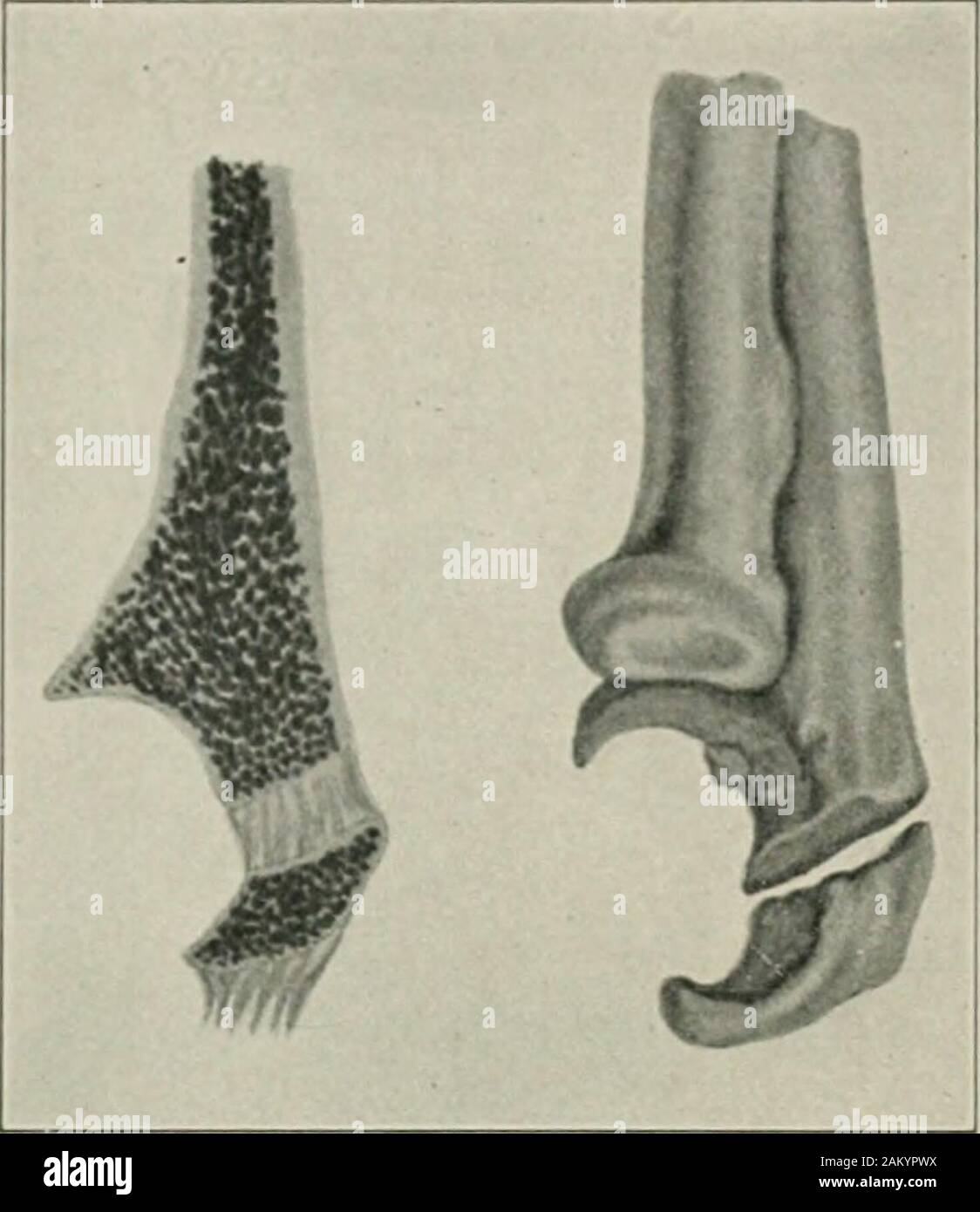 Fracture olecranon process of ulna hi-res stock photography and images ...
