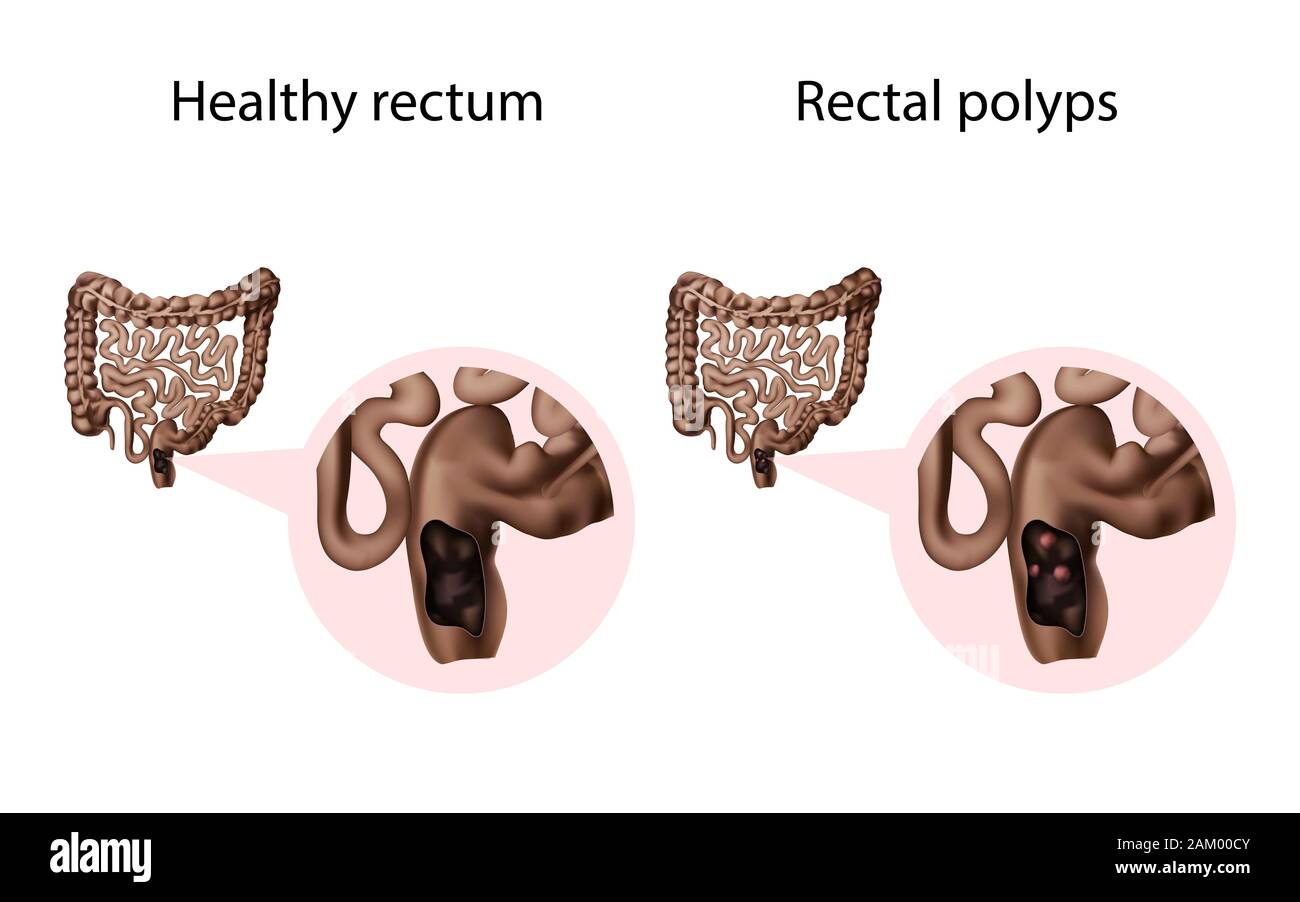 Normal rectum High Resolution Stock Photography and Images - Alamy