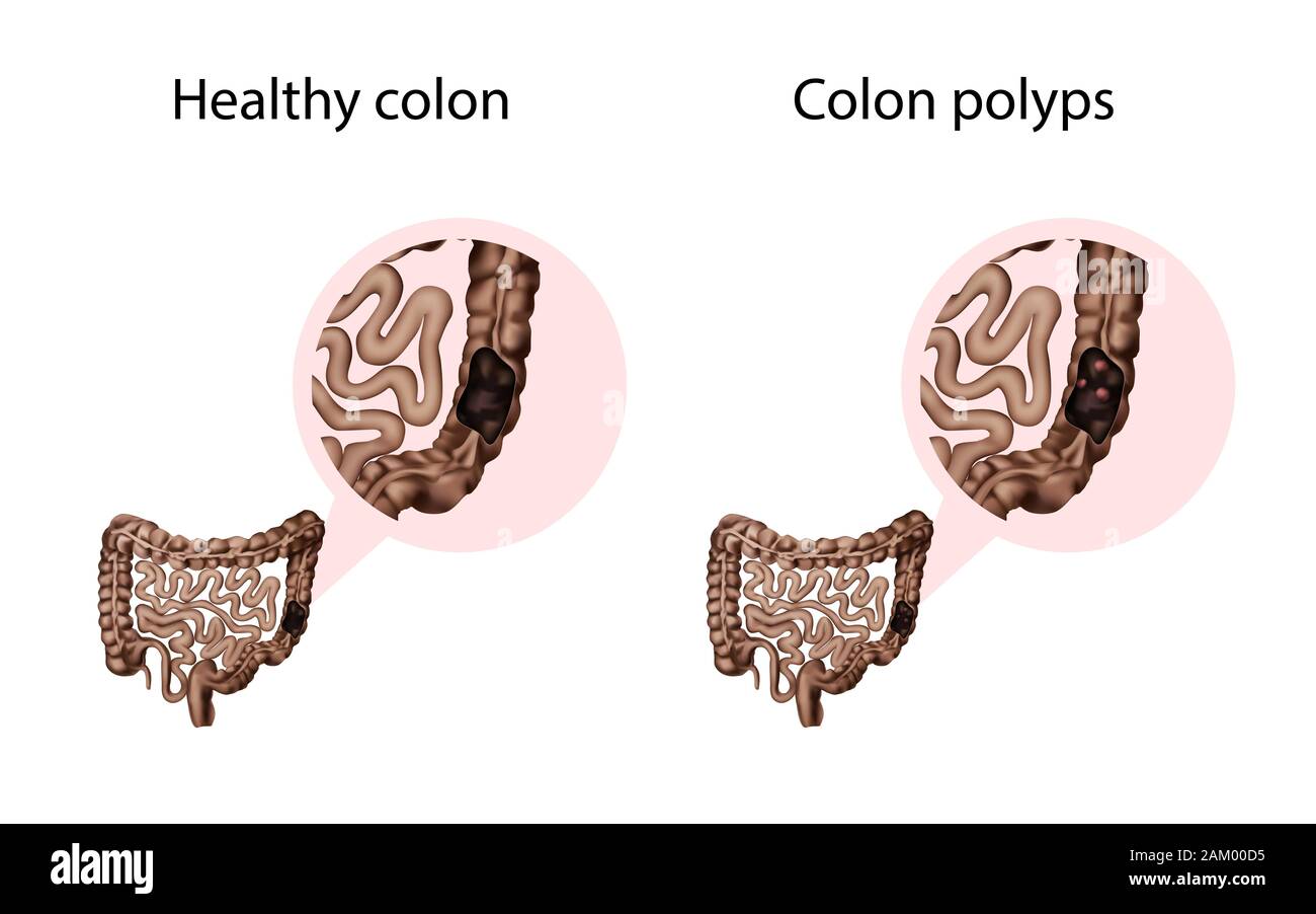 Polyps of the colon Cut Out Stock Images & Pictures - Alamy