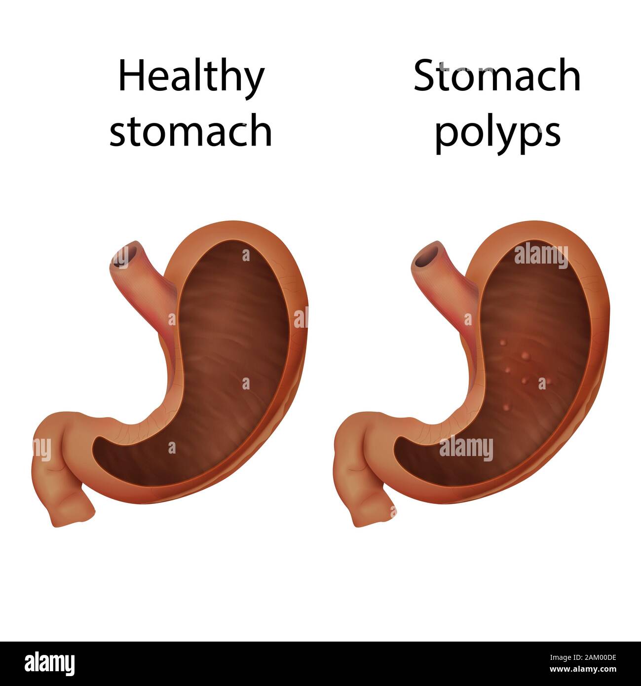 Intestinal Polyps Symptoms