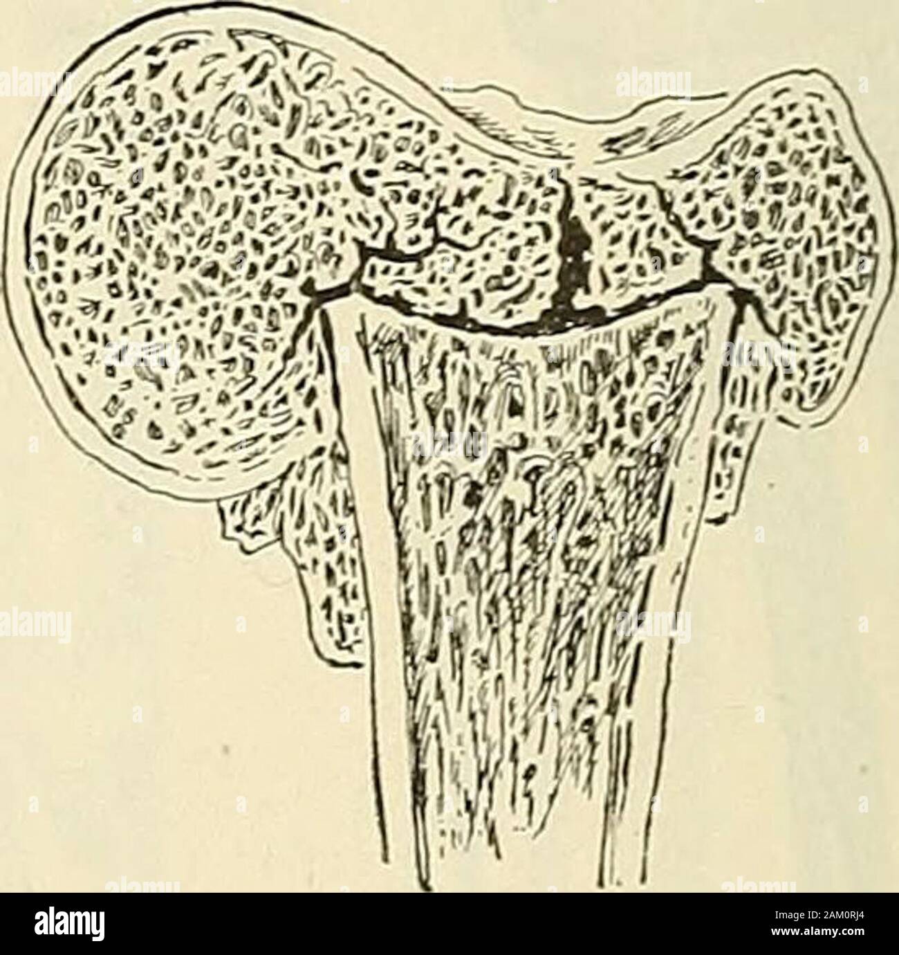 Impacted fracture hi-res stock photography and images - Alamy