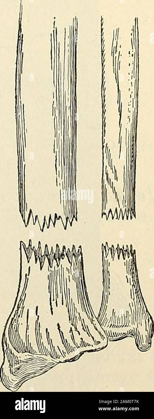 Serrated Fracture Definition