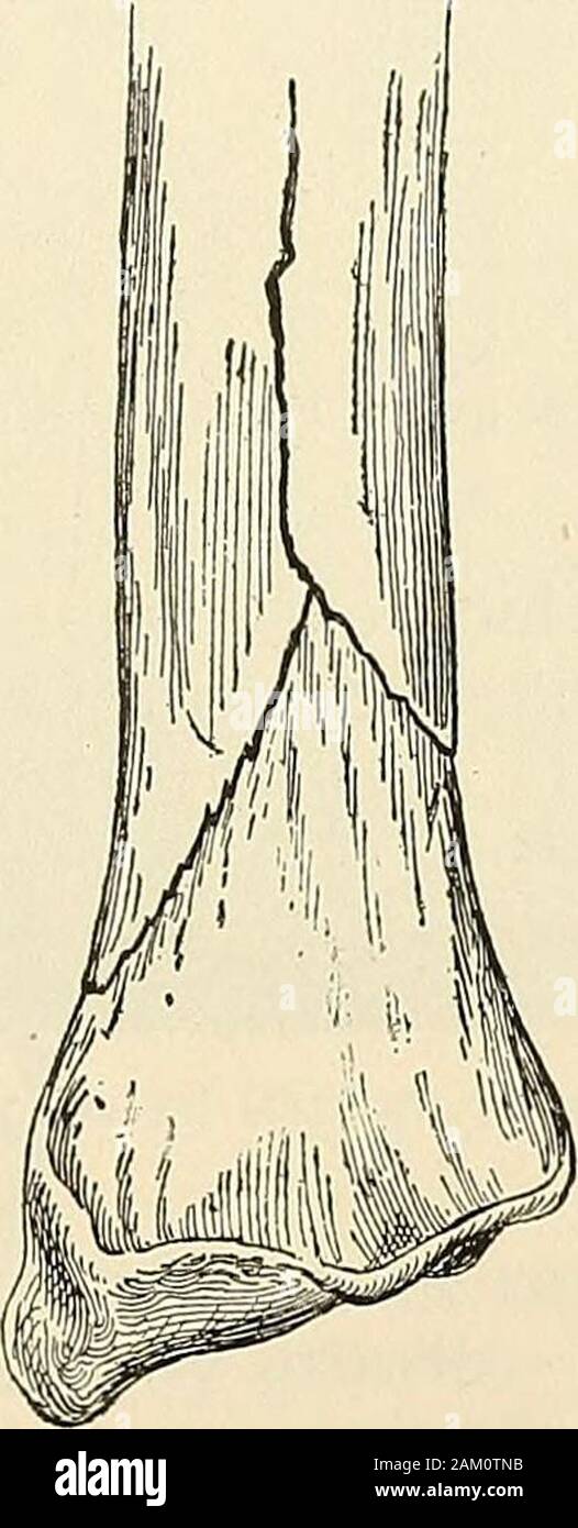 Modern surgery, general and operative . ure.—The breaking off of a ...