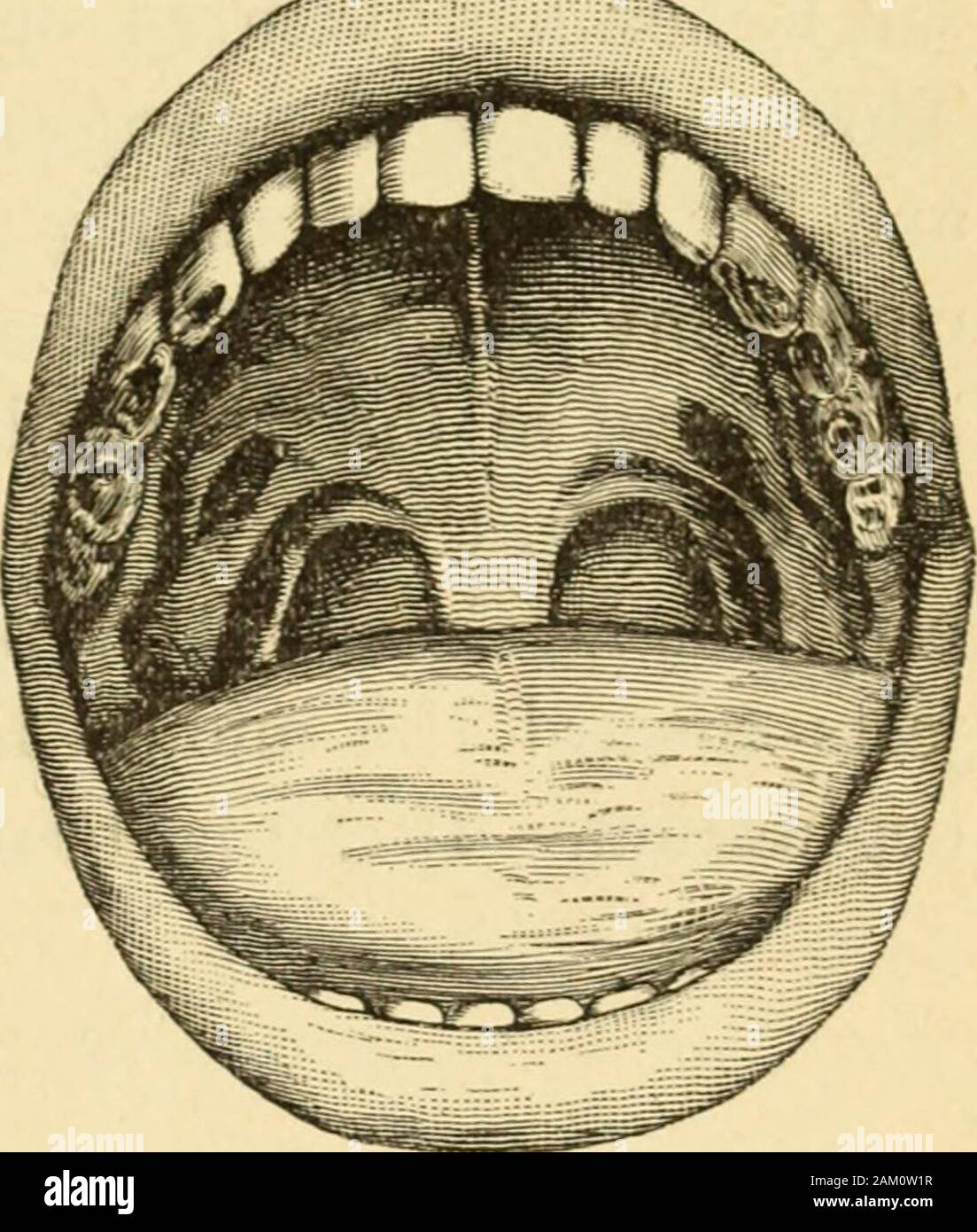 Bifid uvula hi-res stock photography and images - Alamy