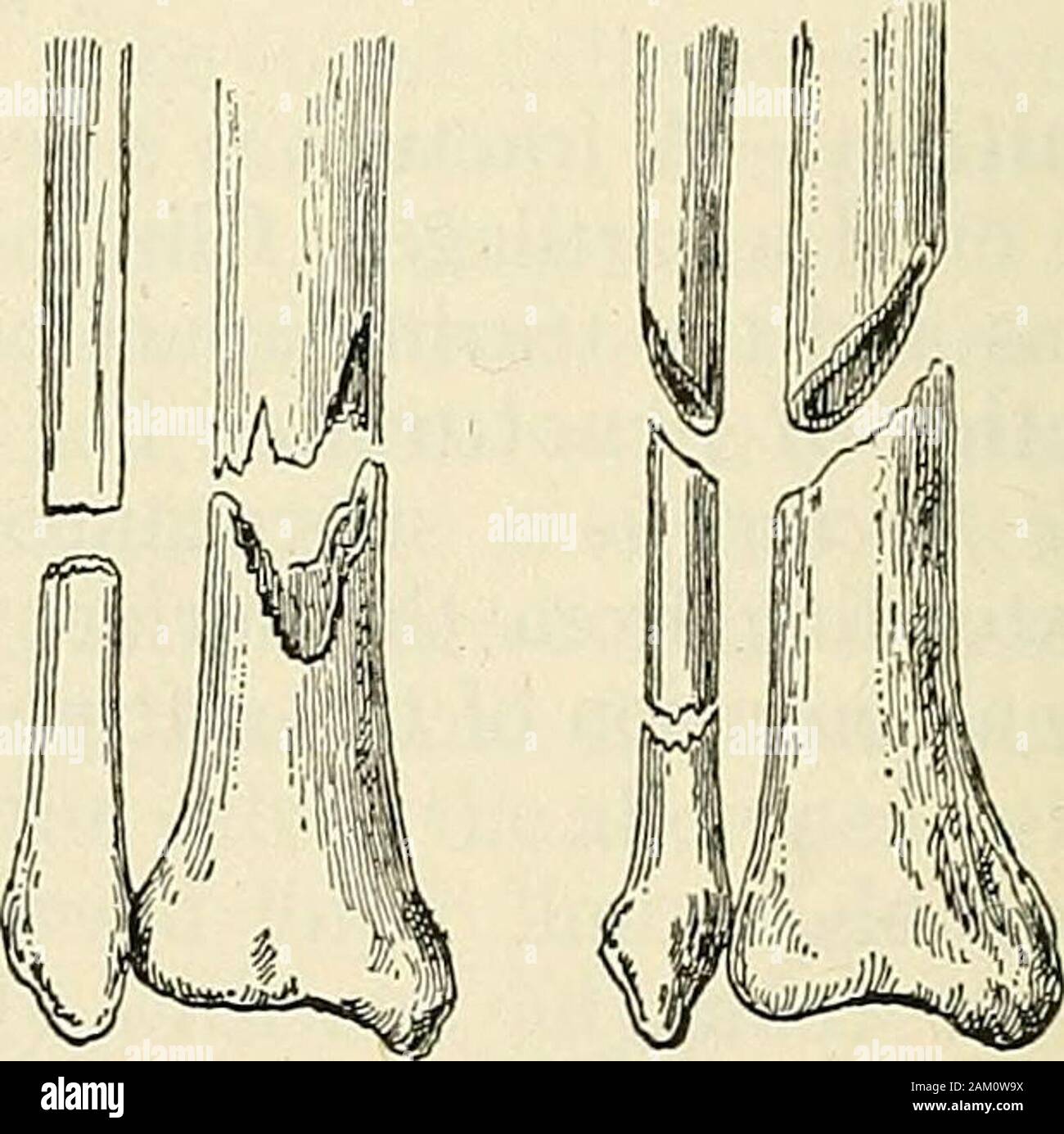 Modern surgery, general and operative . Fig. 261.—Complete fractures: a ...