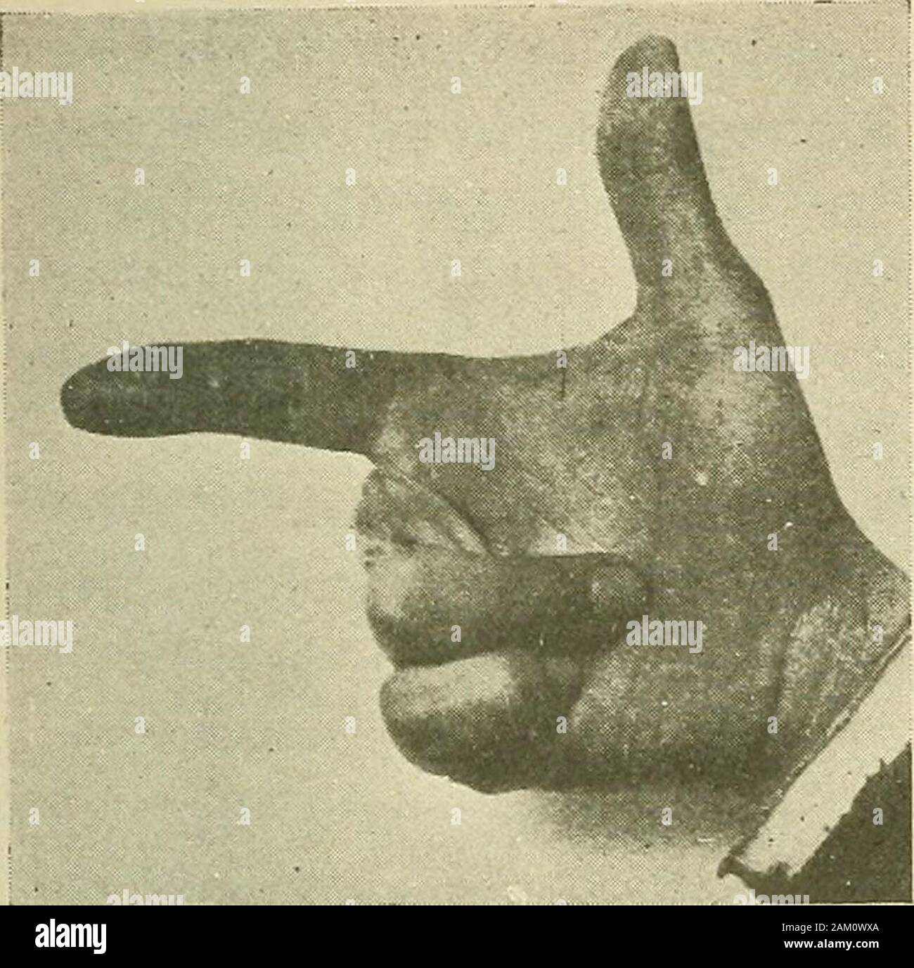 Medical and surgical therapy . tlefingers began to flex ; this flexion ...