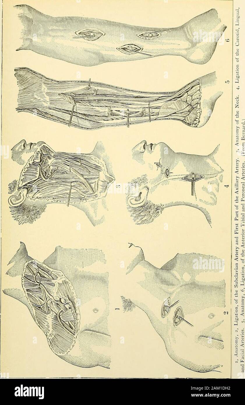 Modern surgery, general and operative . brought down along the side. In ...
