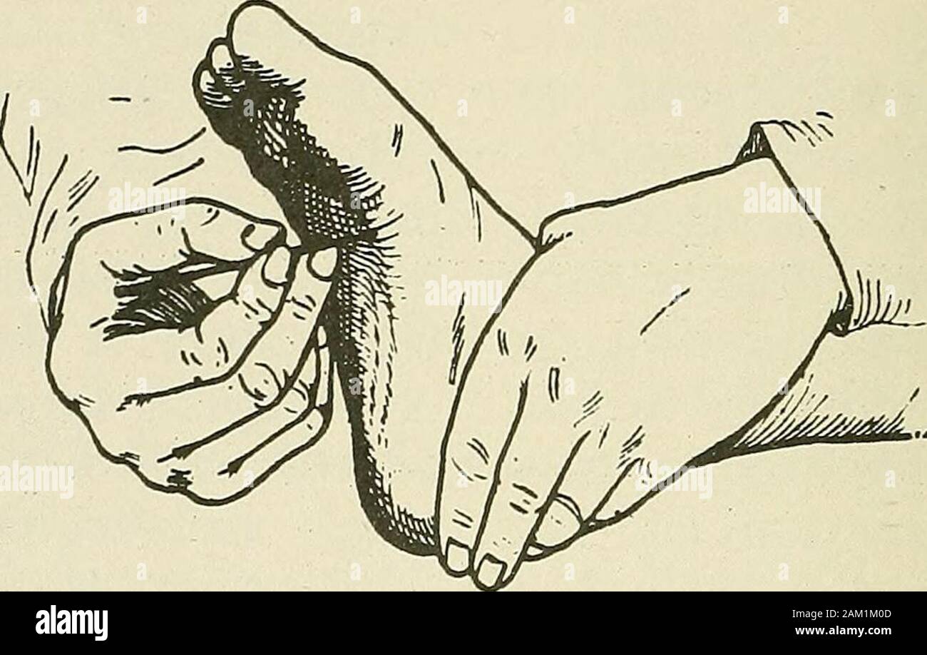 Medical and surgical therapy . limb sway-ing to and fro like a ...