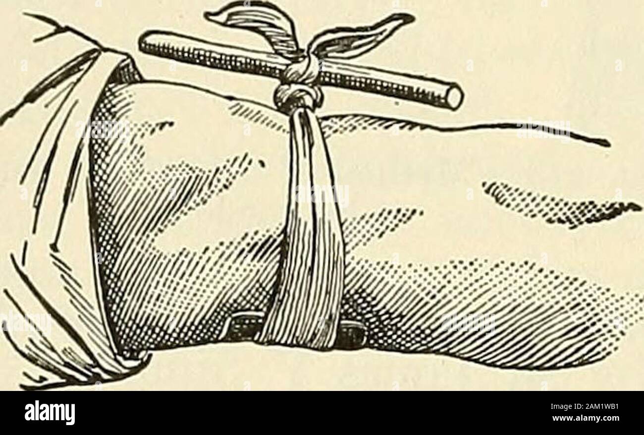 Modern surgery, general and operative . arrest bleeding from the ...