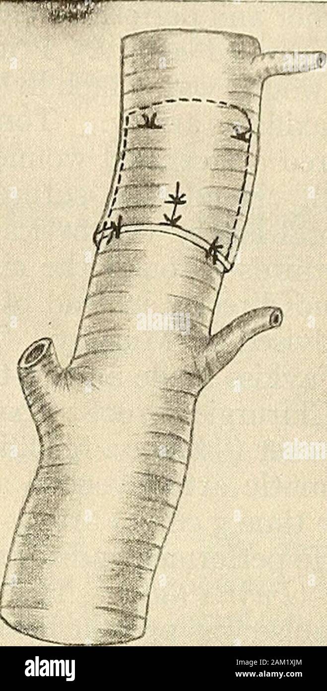 Intussusception hi-res stock photography and images - Alamy