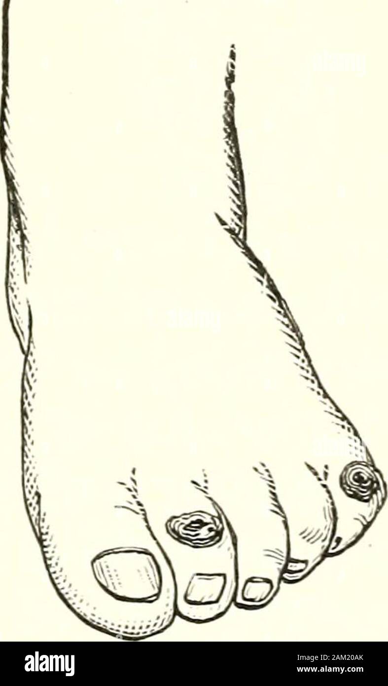 Necrosis of toe hi-res stock photography and images - Alamy