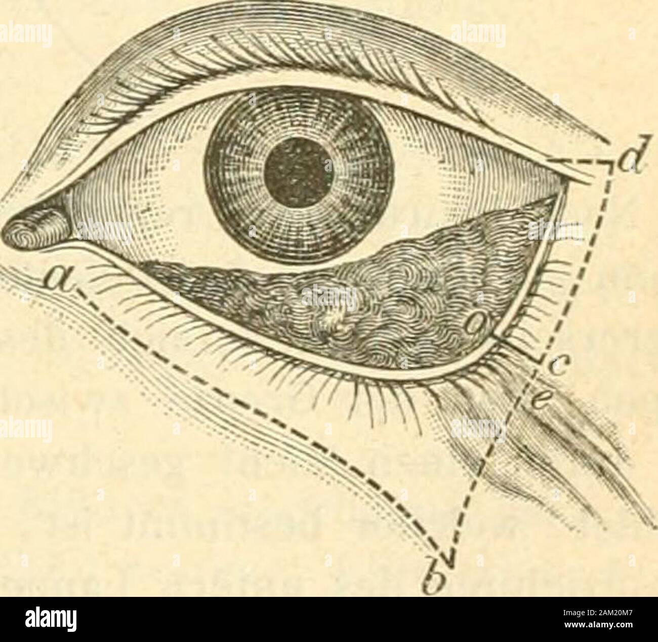 Bindehaut ektropium hi-res stock photography and images - Alamy