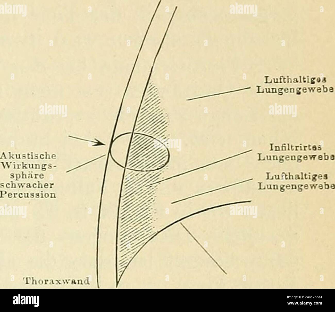 Exsudat hi-res stock photography and images - Alamy