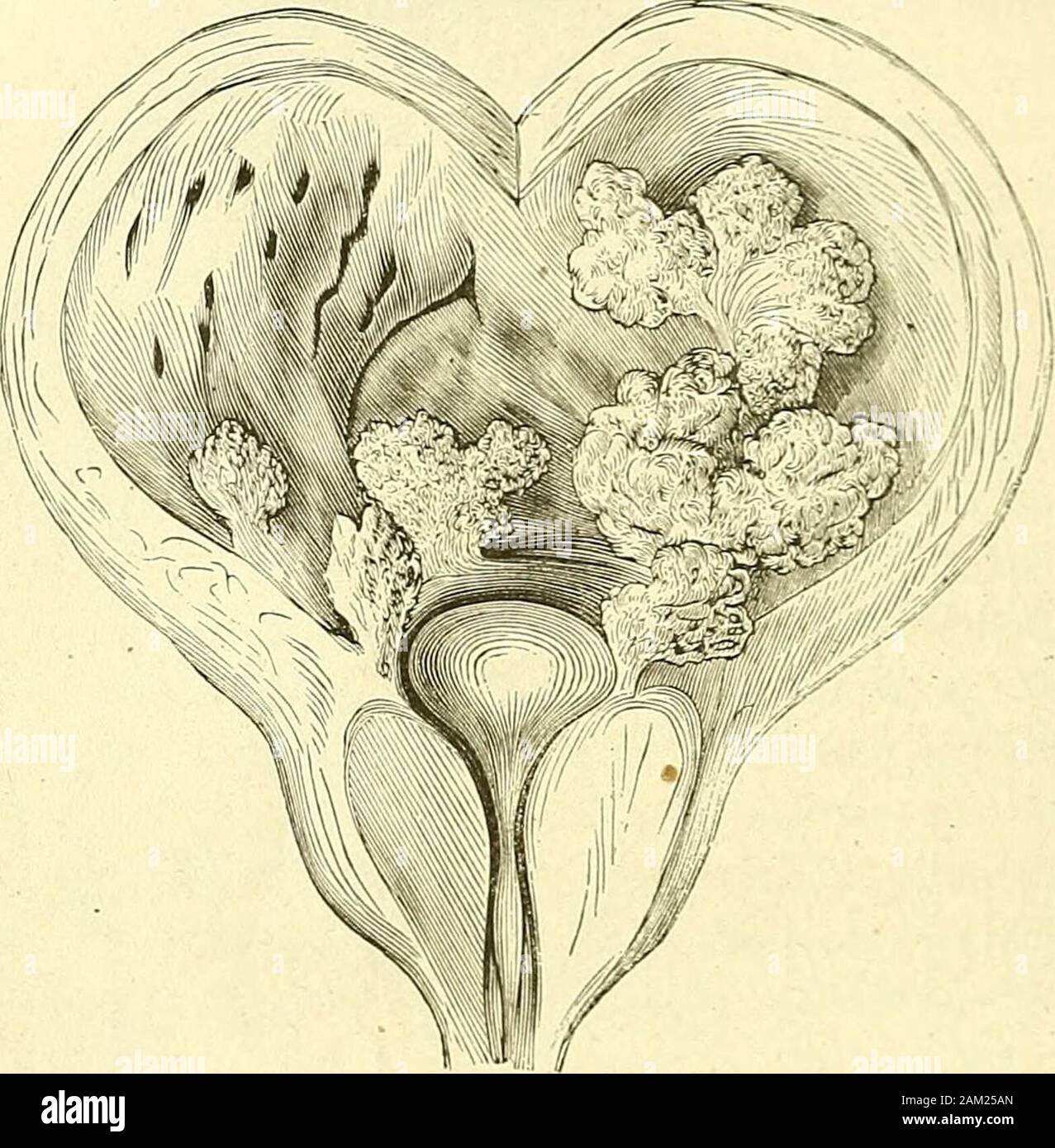 Prostate et vessie hi-res stock photography and images - Alamy