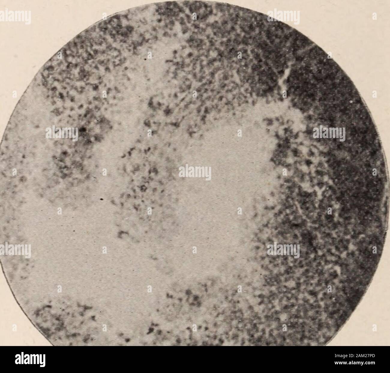 Lead poisoning gums hi-res stock photography and images - Alamy