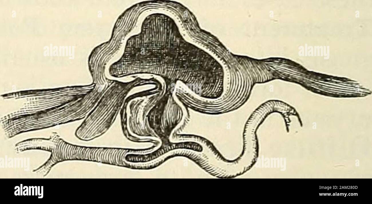 Venesection hi-res stock photography and images - Alamy