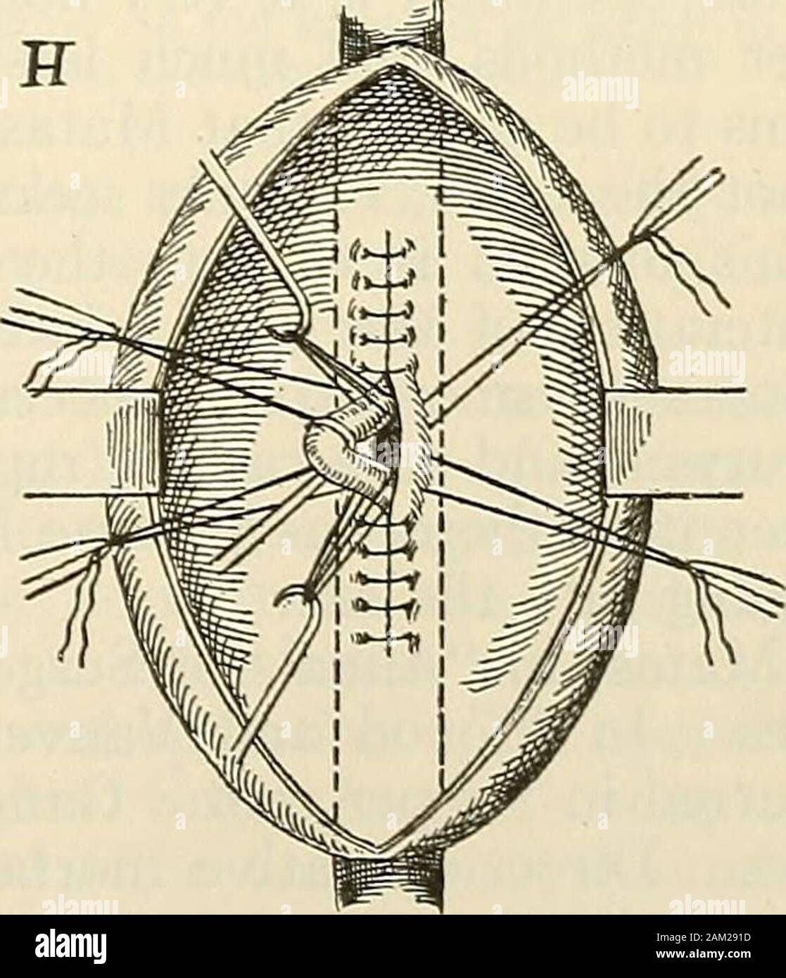 Modern surgery, general and operative . Fig. 196.—^The radical cure of ...