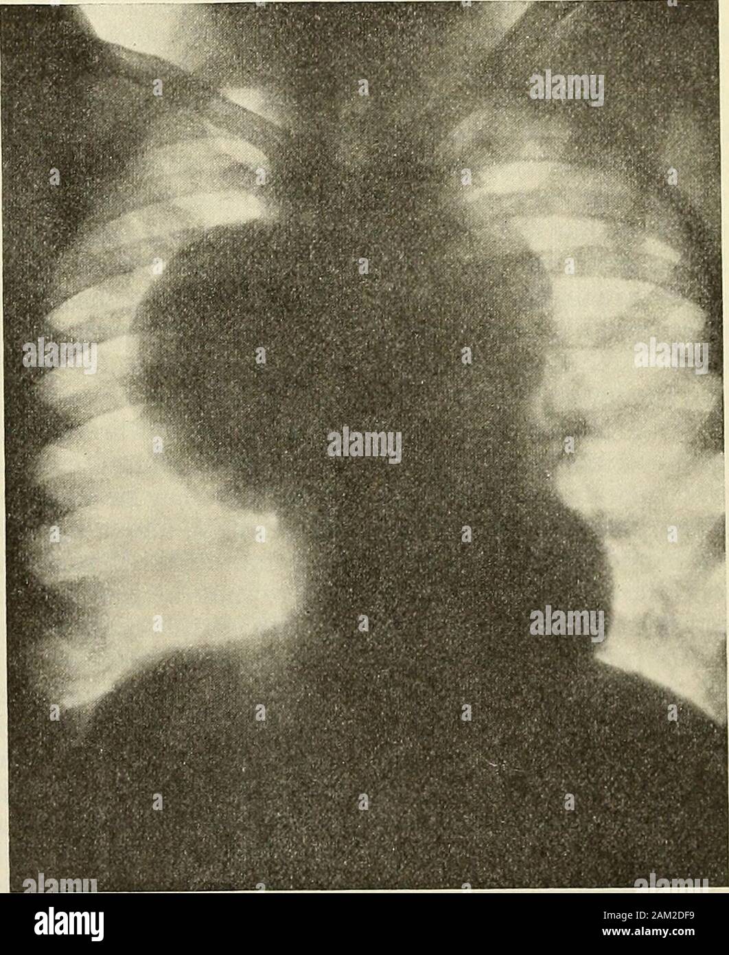 Modern surgery, general and operative . Fig. 189.—Radial pulse-tracings ...