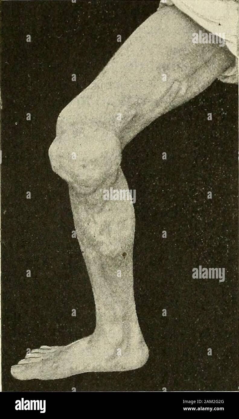 Phlebectasis hi-res stock photography and images - Alamy