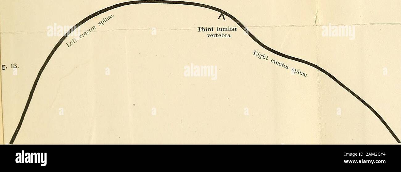 The treatment of lateral curvature of the spine : with appendix giving ...