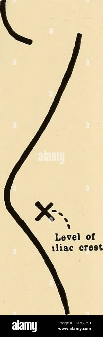 Abnormal Gluteal Cleft
