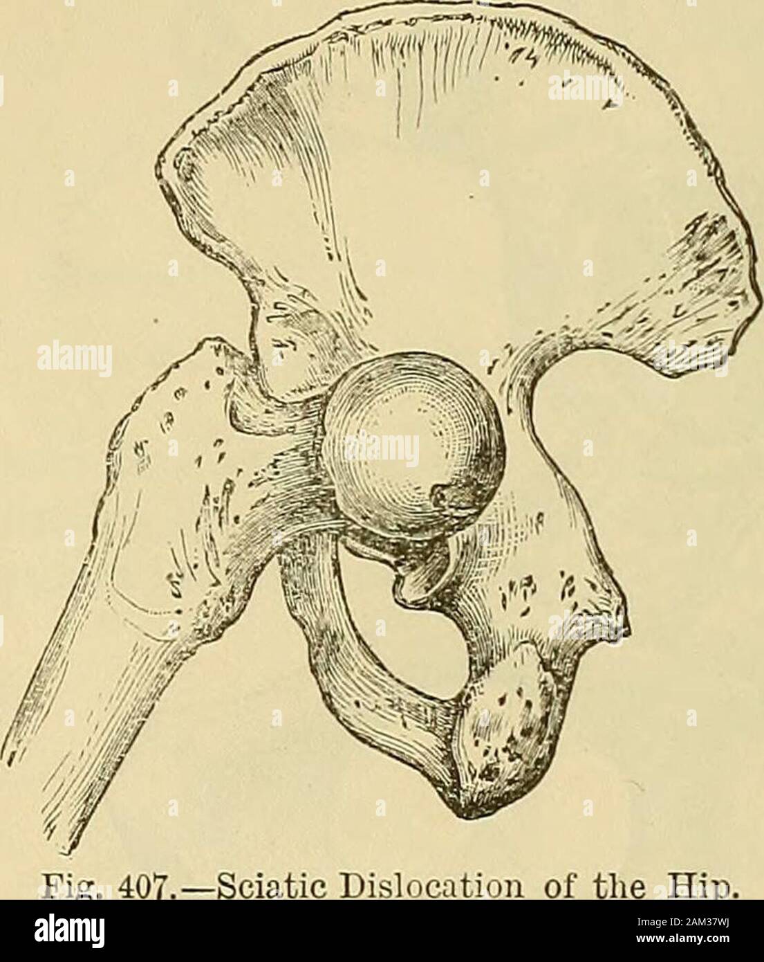 A system of surgery . isa little raised, and the fold of the buttock ...