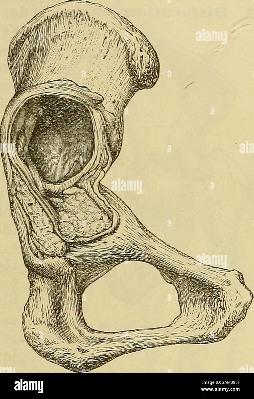A system of surgery . Fig. 406.—Unreduced Backward Dislocation of the ...