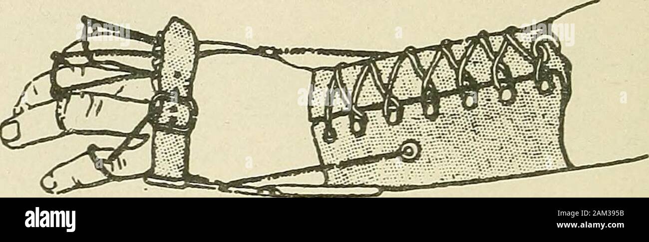 Medical and surgical therapy . Pig. 36.—Appliance for correction of ...