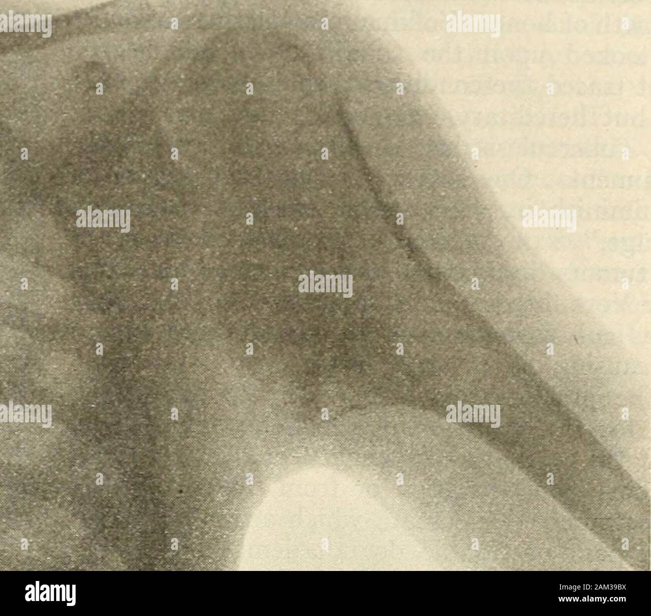 Cancellous and compact bone hi-res stock photography and images - Alamy