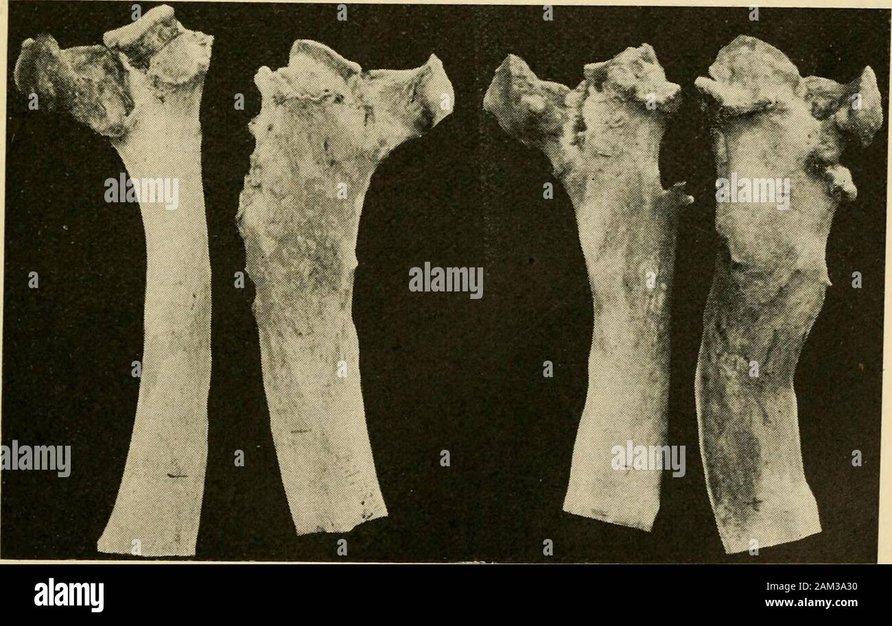 First rib fracture hi-res stock photography and images - Alamy