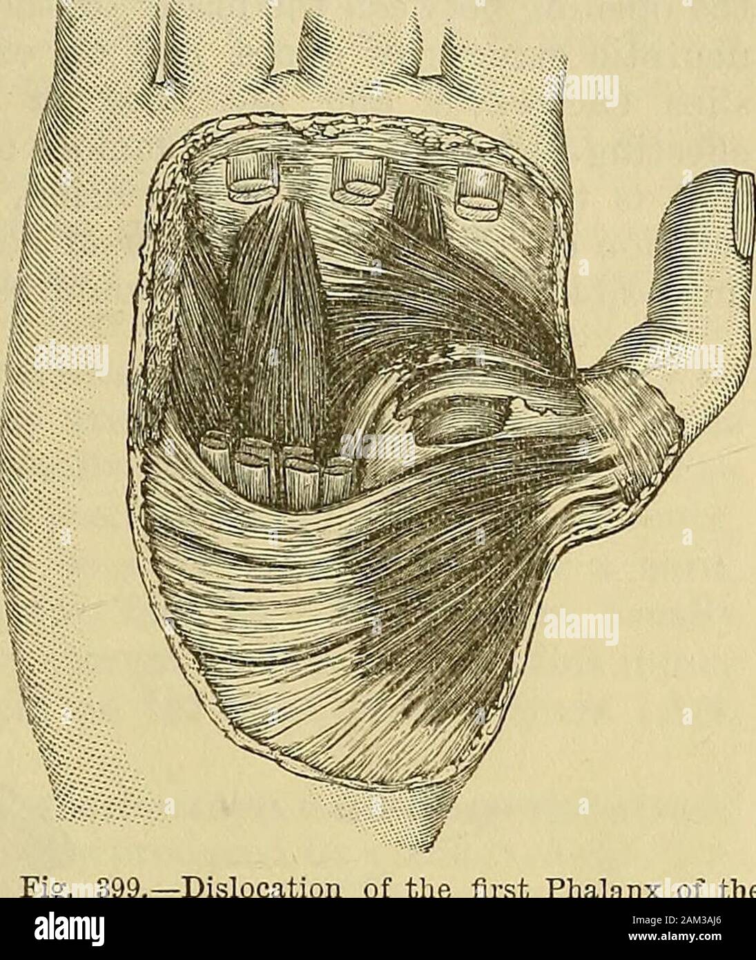 Metacarpal dislocation hi-res stock photography and images - Alamy
