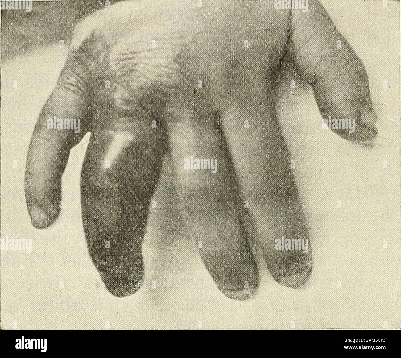 Dactylitis High Resolution Stock Photography and Images - Alamy