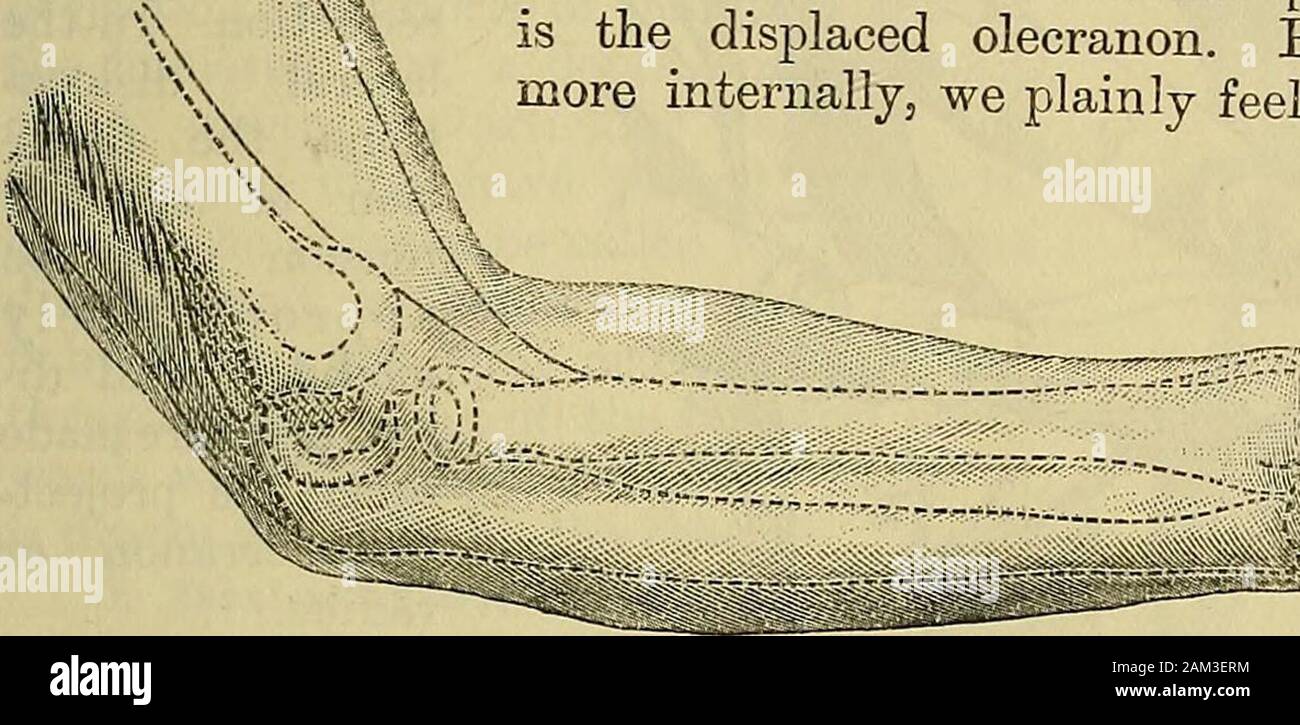 Ulnar nerve surgery hi-res stock photography and images - Alamy