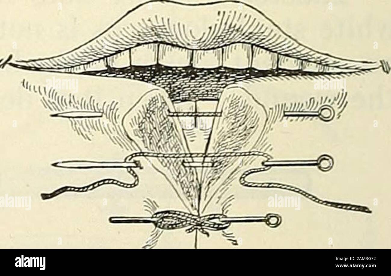 Modern surgery, general and operative . cerated wound. The thumbor a ...