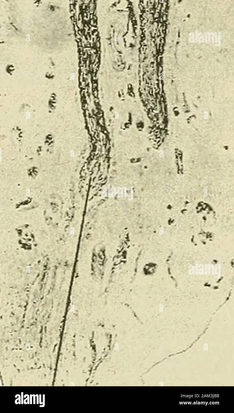 Endarteritis hi-res stock photography and images - Alamy